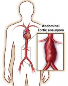 Aortic Aneurysm-AAA/Thoracic Aneurysm TAA - AZ Vascular Specialists
